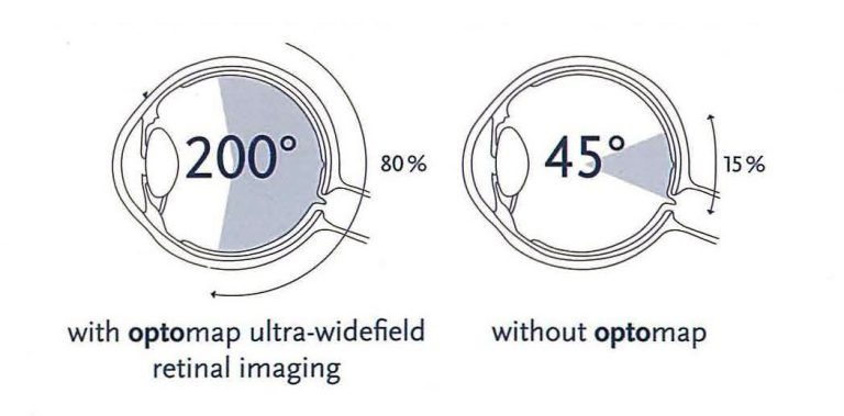 Optomap Retinal Exam – Chorney Vision Centre
